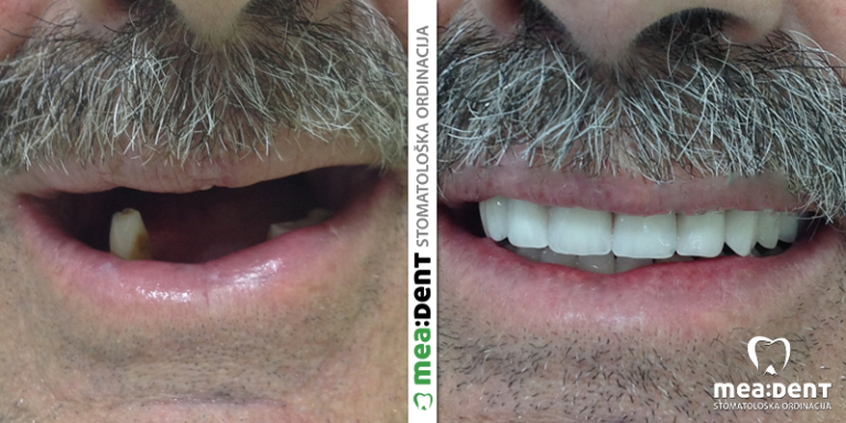 Vizil proteza i keramički zubi | M.K. 72 godine - MEA:DENT